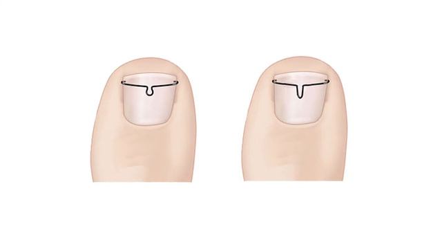 Вросший ноготь без операции. Лечение подологом вросшего ногтя без операции. Подологи МНПЦДК.