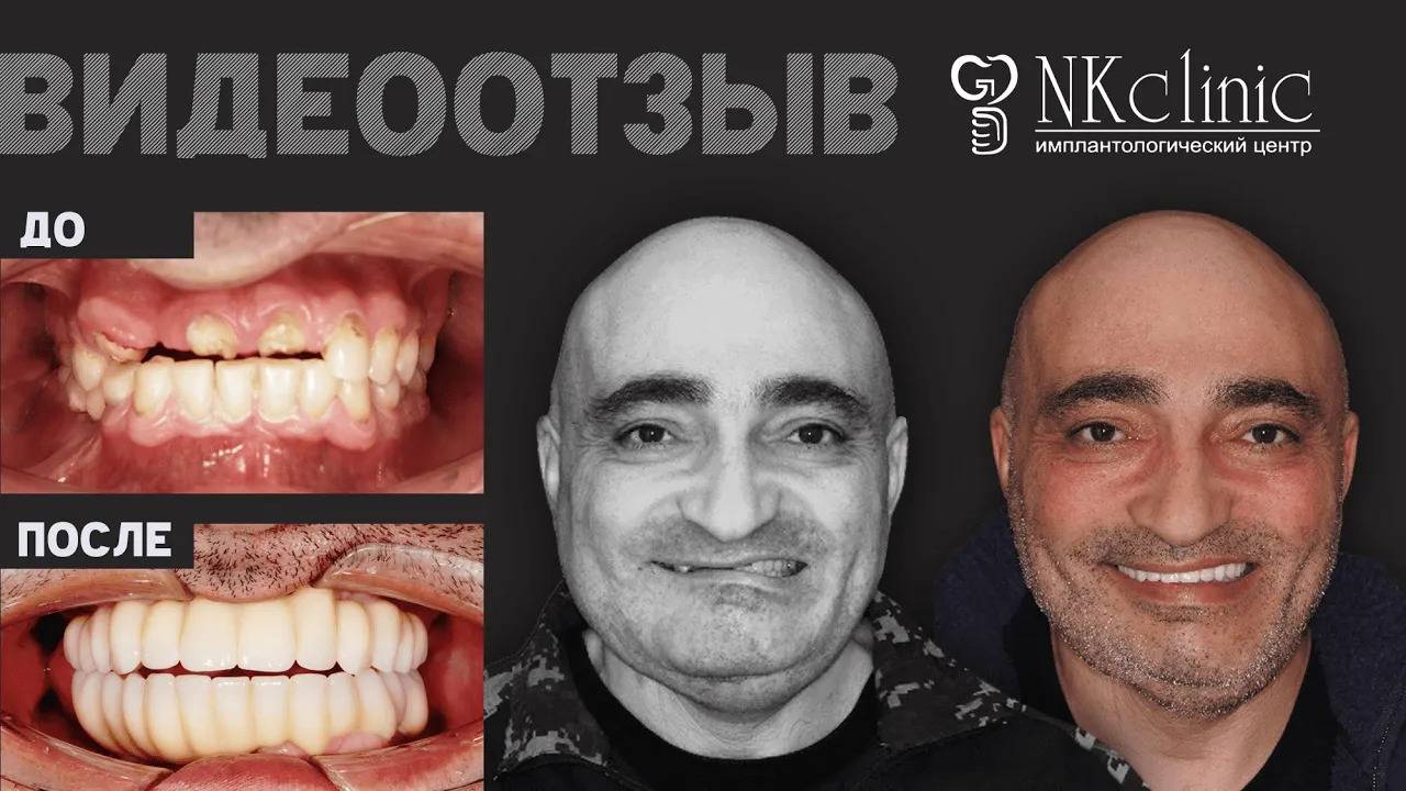 #NKclinic_отзывы. Удалили опухоль и восстановили челюсть за одну операцию.