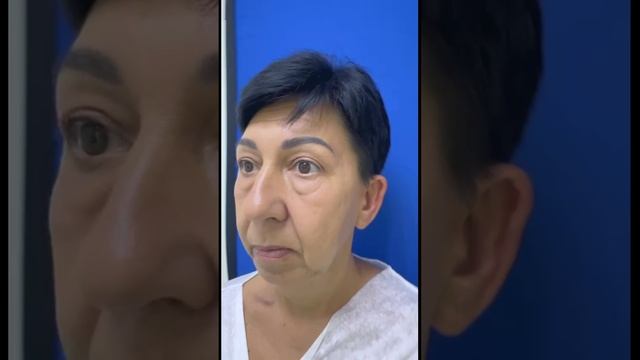 Отзыв Елены о блефаропластике в Институте на Трубной. Хирург - Плотникова М.В.