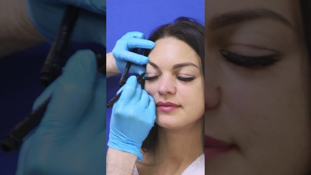 Нанесение разметки перед круговой блефаропластикой.