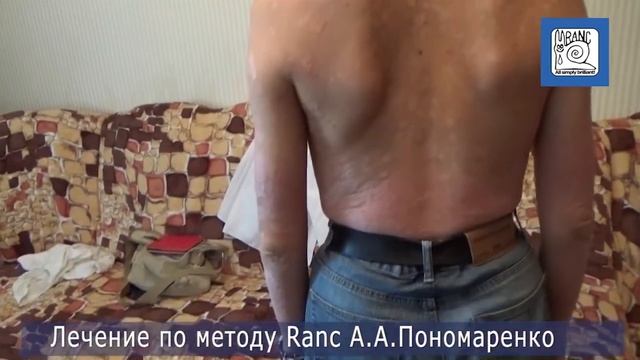 538. ПСОРИАЗ ЛЕЧИТСЯ МЕТОДОМ RANC! Воронеж