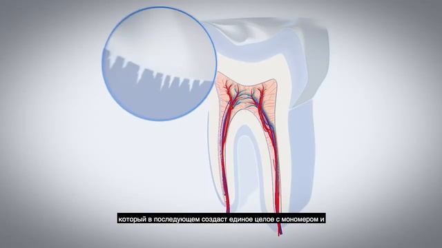 UltraSeal XT hydro - настоящий прорыв в области фиссурных герметиков