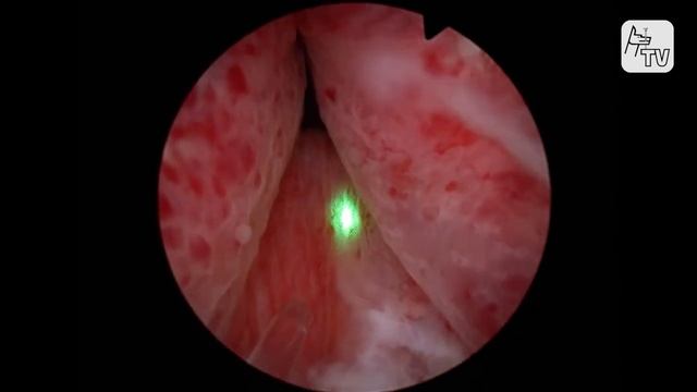 Лазерная энуклеация предстательной железы