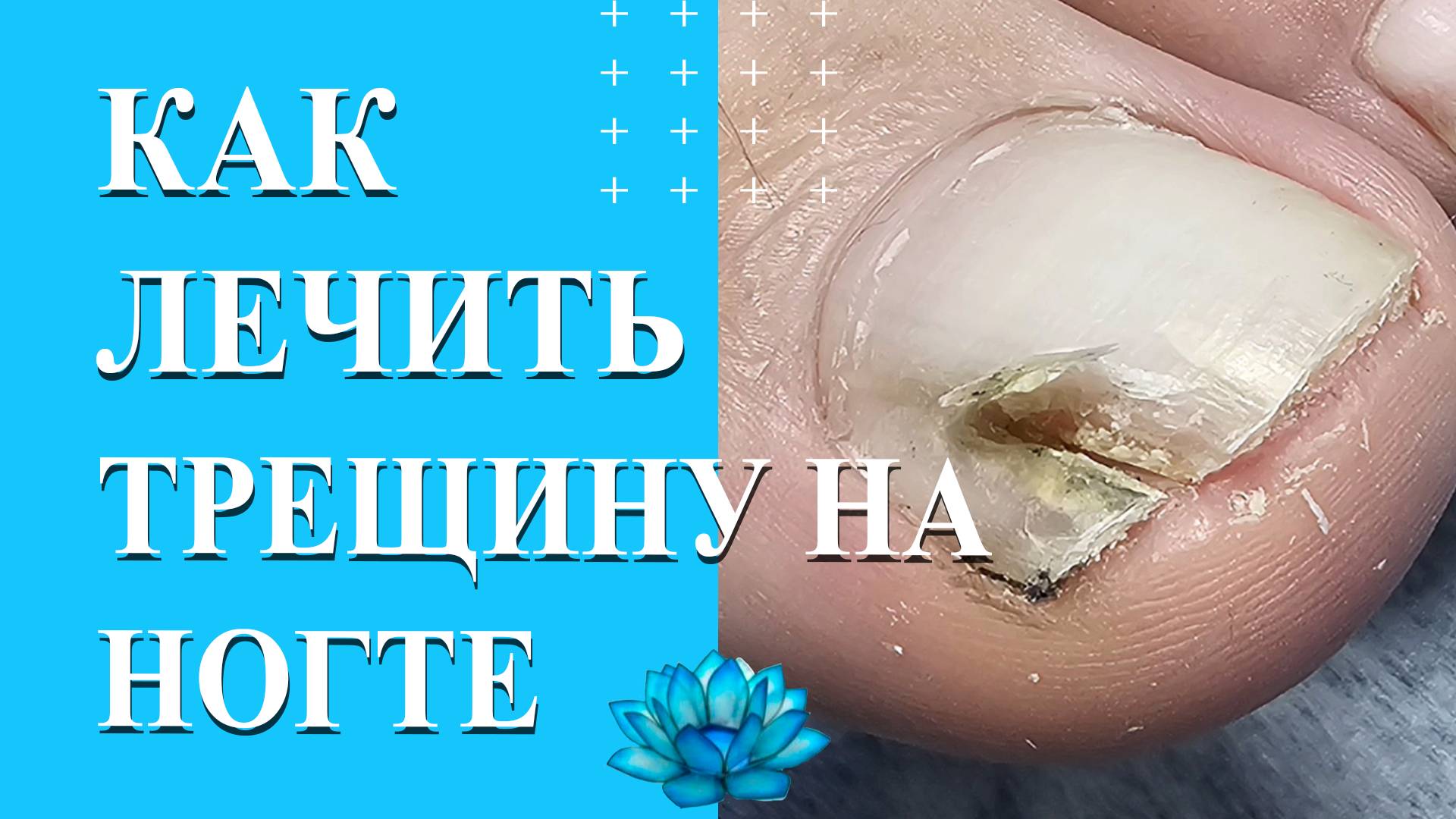Онихорексис, что это? Трещина на ногте, как убрать.