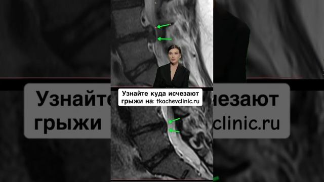Грыжи позвоночника. Куда они уходят ?