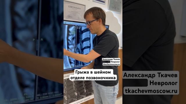 Грыжа в шейном отделе позвоночника. Лечение по методу резорбции.
