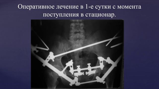 7. Новое поколение аппаратов внешней фиксации - лечение нестабильных повреждений таза