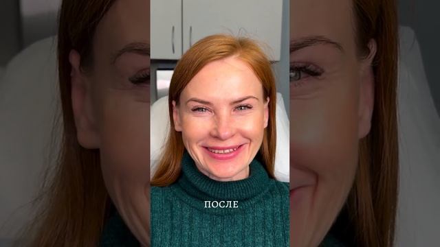 Избавляемся от морщин

На видео результат до и спустя 14 дней после ботулинотерапии💉