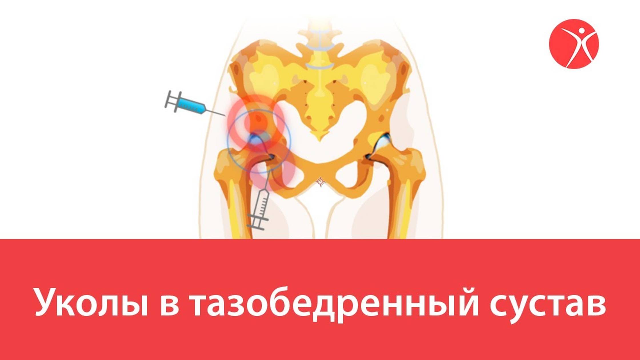 Уколы в тазобедренный сустав