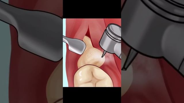 Как удаляют зуб мудровсти