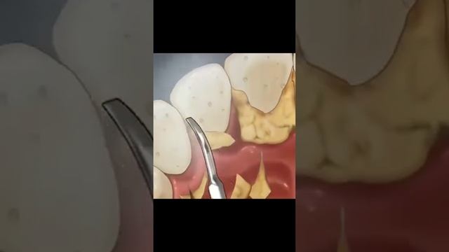 Чистка зубного камня