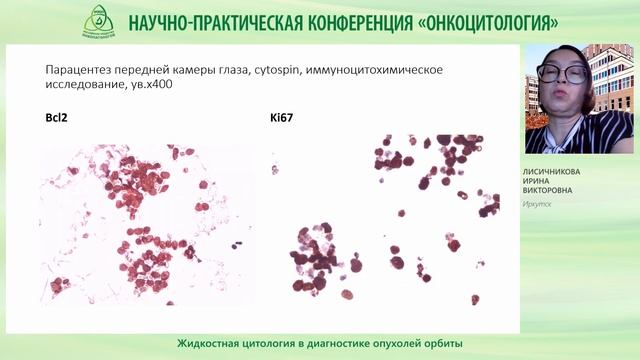 Жидкостная цитология в диагностике опухолей орбиты