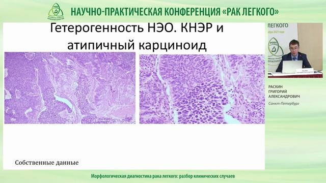 Саркома интимы легочной артерии