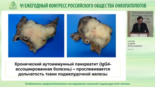Особенности макроскопического исследования опухолейподжелудочной железы