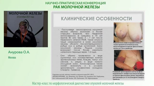 Постлучевая ангиосаркома молочной железы