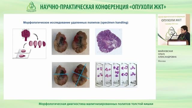Морфологическая диагностика малигнизированных полипов толстой кишки
