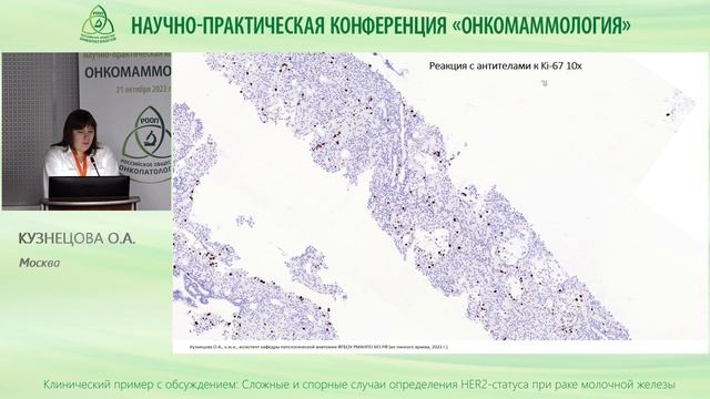 Сложные и спорные случаи определения HER2 статуса при раке молочной железы