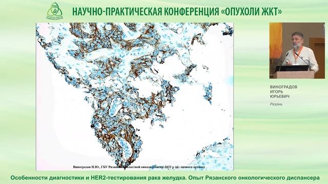 Особенности диагностики и HER2 тестирования рака желудка  Опыт Рязанского онкологического диспансера
