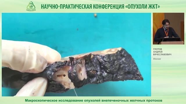 Макроскопическое исследование опухолей внепеченочных желчных протоков