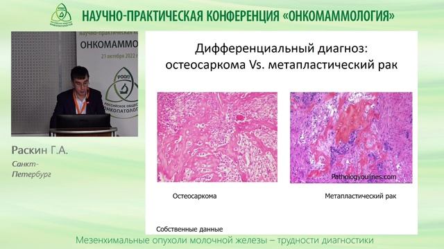 Мезенхимальные опухоли молочной железы