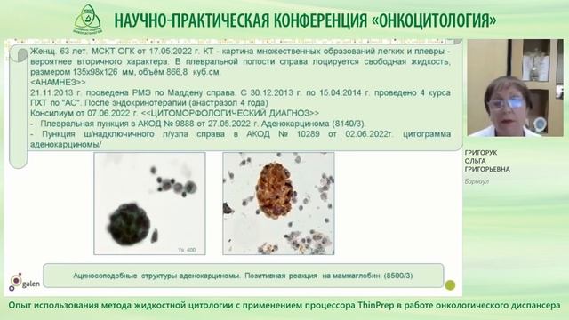Опыт использования метода жидкостной цитологии с применением процессора ThinPrep