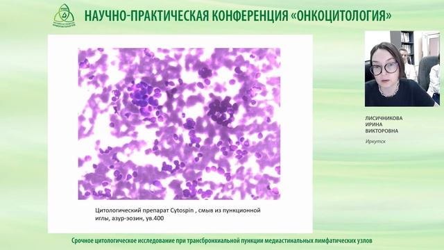 Срочное цитологическое исследование при трансбронхиальной пункции медиастинальных лимфоузлов