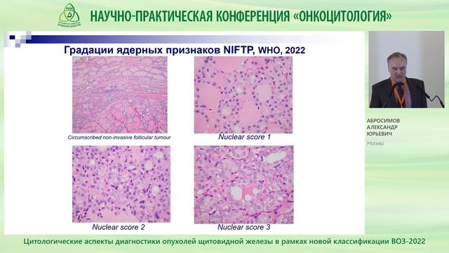 Цитологические аспекты диагностики опухолей щитовидной железы