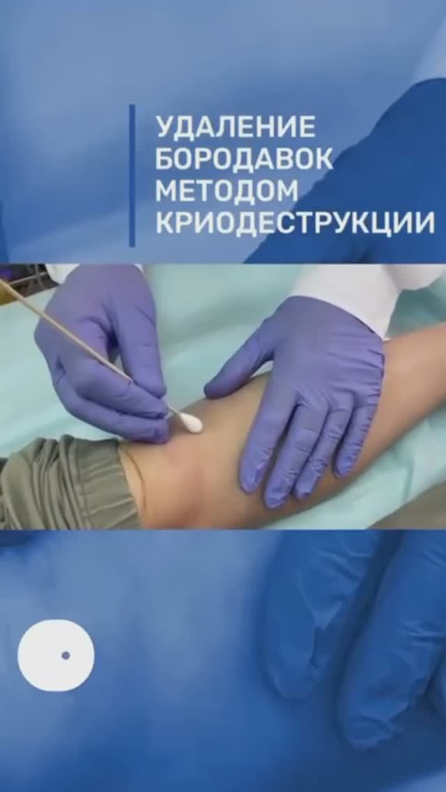 Удаление бородавок