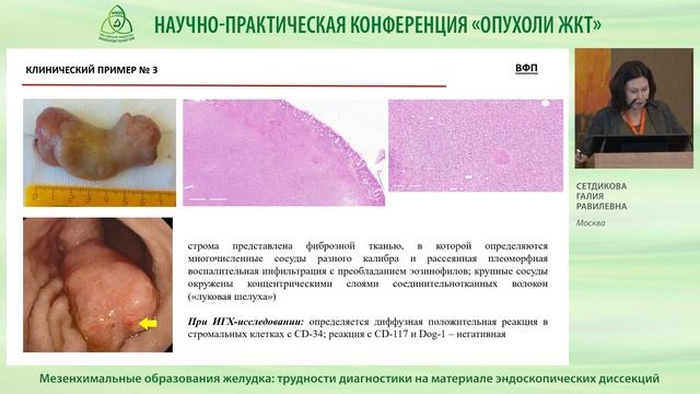 Мезенхимальные образования желудка – трудности диагностики на материале  эндоскопических диссекций