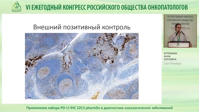Применение набора PD L1 IHC 22C3 pharmDx в диагностике онкологических заболеваний