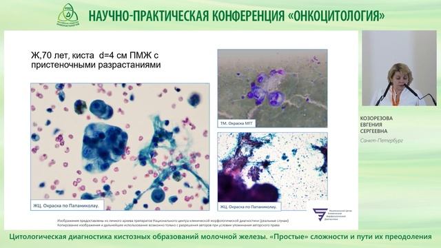 Цитологическая диагностика кистозных образований молочной железы