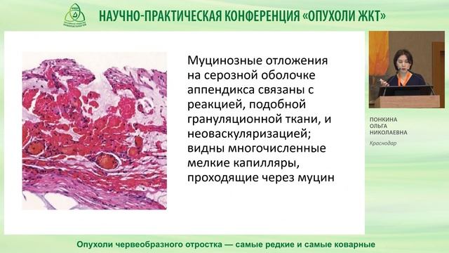 Опухоли червеобразного отростка — самые редкие и самые коварные