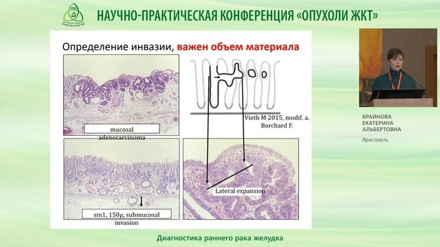 Диагностика раннего рака желудка