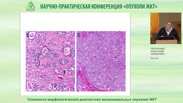 Сложности морфологической диагностики мезенхимальных опухолей ЖКТ