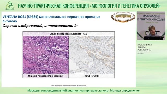 Маркеры сопроводительной диагностики при раке легкого  Методы определения