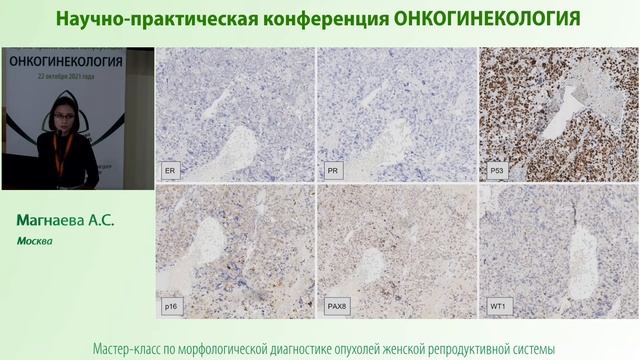 Хорионкарцинома яичника, неассоциированная с беременностью, у пациентки в постменопаузе