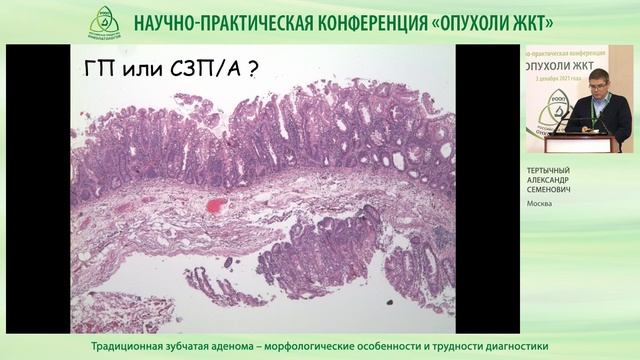 Традиционная зубчатая аденома – морфологические особенности и трудности диагности