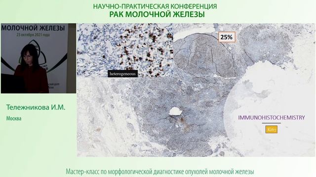 Аденокистозный рак молочной железы