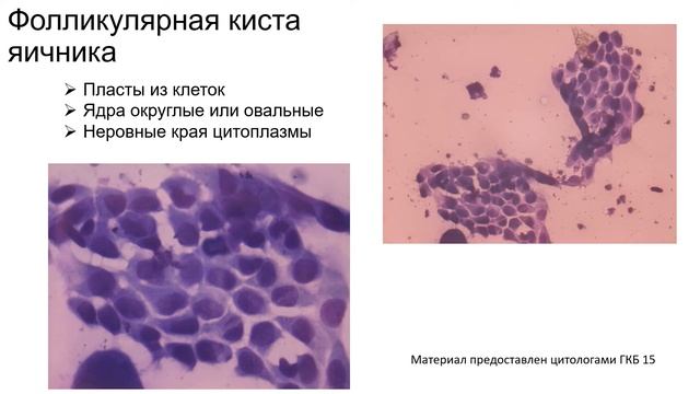 Опыт применения цитологического исследования в диагностике опухолей яичника