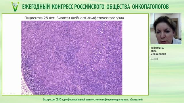 Экспрессия CD30 в дифференциальной диагностике лимфопролиферативных заболеваний