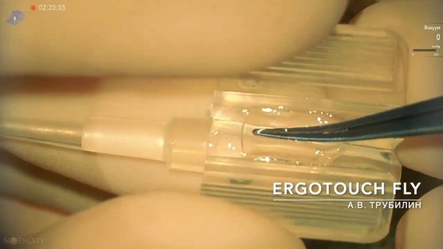 Процесс имплантации ИОЛ Sidapharm