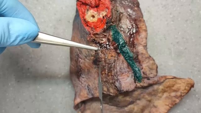 Макроскопическое исследование опухолей легкого. Центральный рак