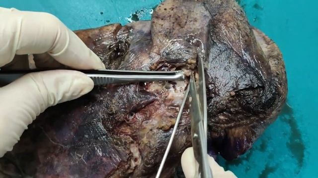 Макроскопическое исследование опухолей легкого  Периферический рак