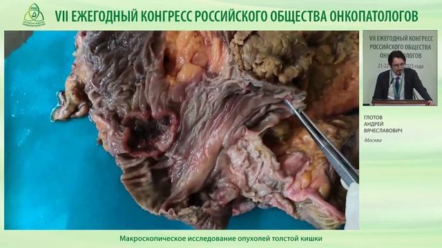 Макроскопическое исследование опухолей толстой кишки