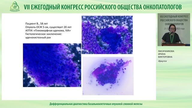 Дифференциальная диагностика базальноклеточных опухолей слюнной железы
