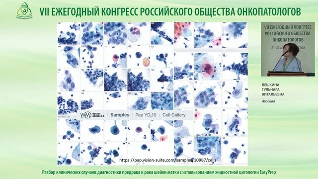 Разбор клинических случаев диагностики предрака и рака шейки матки с использованием цитологии