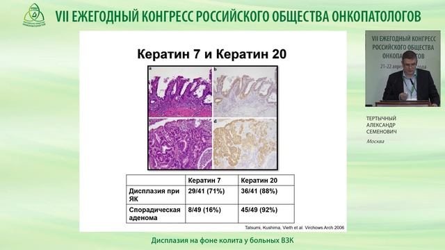Дисплазия на фоне колита у больных ВЗК