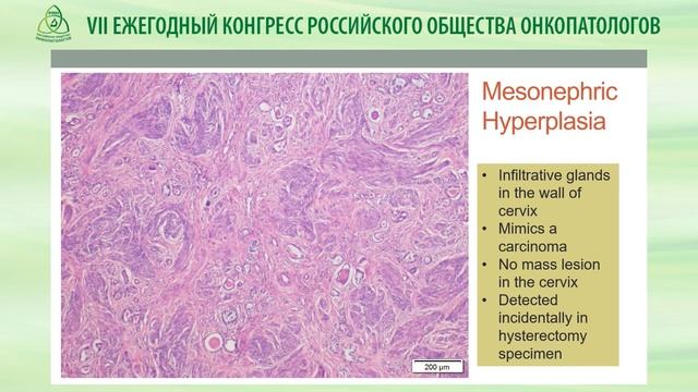 Необычные цервикальные карциномы: карциносаркома, эпителиоидная трофобластическая опухоль и др.