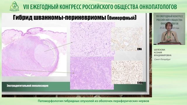 Патоморфология гибридных опухолей из оболочек периферических нервов