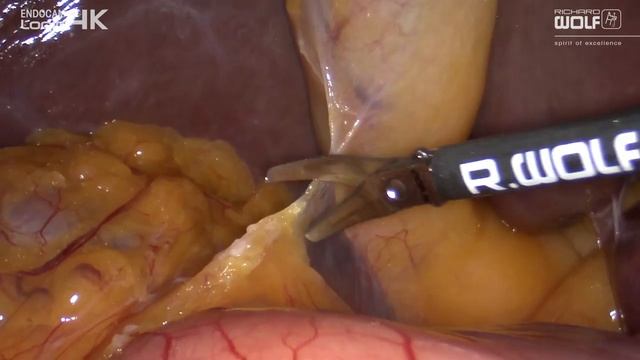 ENDOCAM Logic 4K Ultra HD   Endoaufnahmen